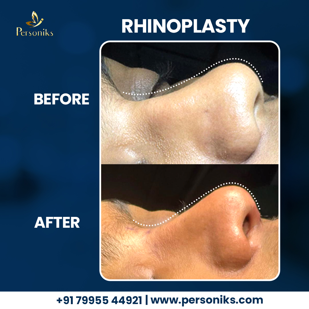 Rhinoplasty (Nose Reshaping) in Hyderabad – A Medically Guided Facial ...